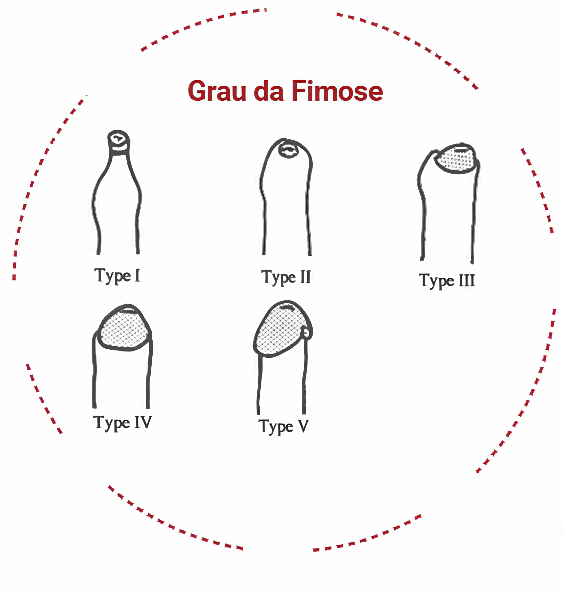 Fimose O Que é Quando E Como Tratar Dr Antônio Soares Urologista